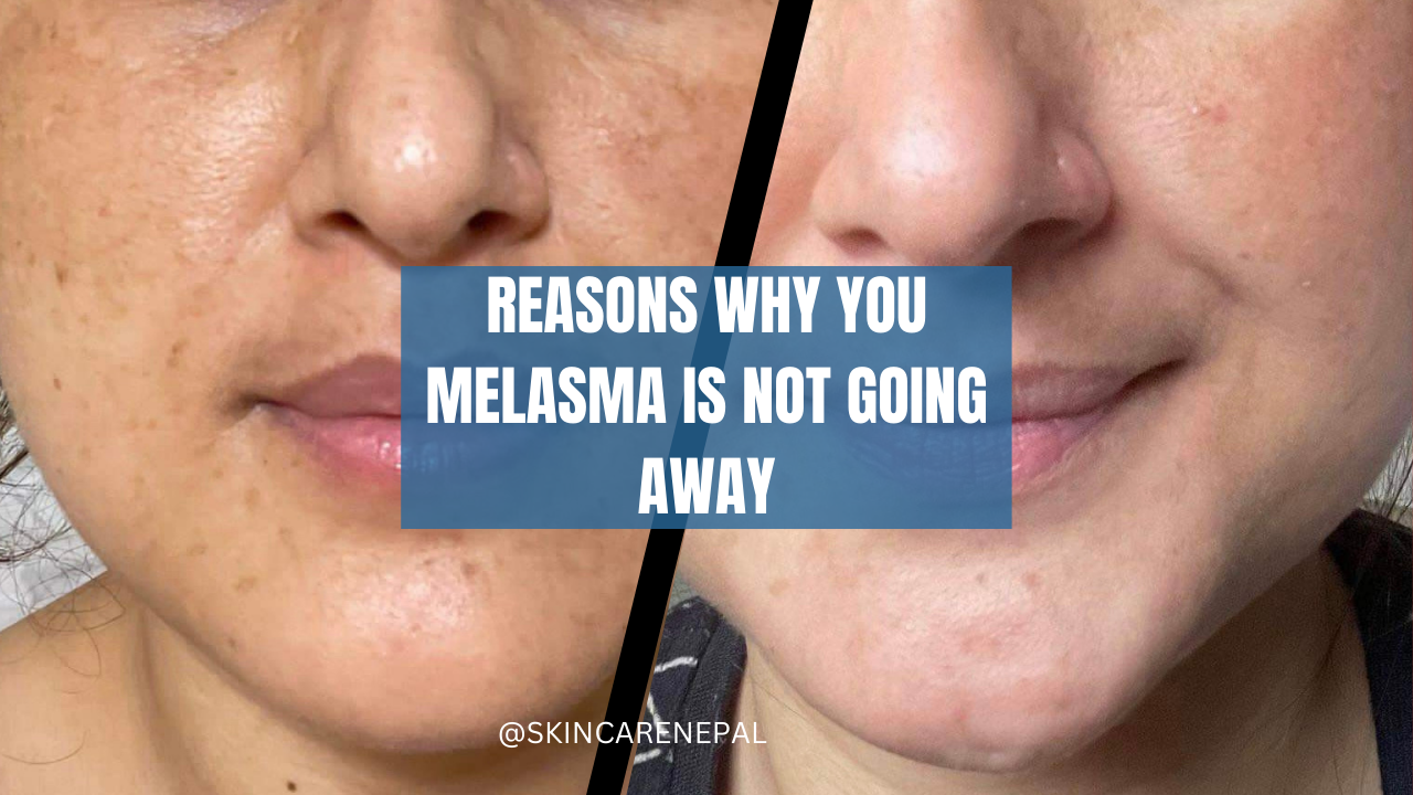 Reasons Why Your Melasma Is Not Going Away - Skincare Nepal